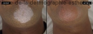 Camouflage du vitiligo par un expert en dermographie réparatrice
