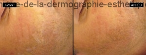 Résultats camouflages cicatrices vitiligo - Clinique de la dermographie ...
